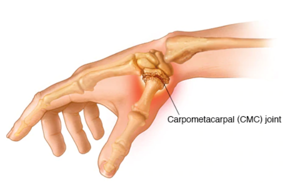 Carpometacarpal Osteoarthritis - Axes PT Blog